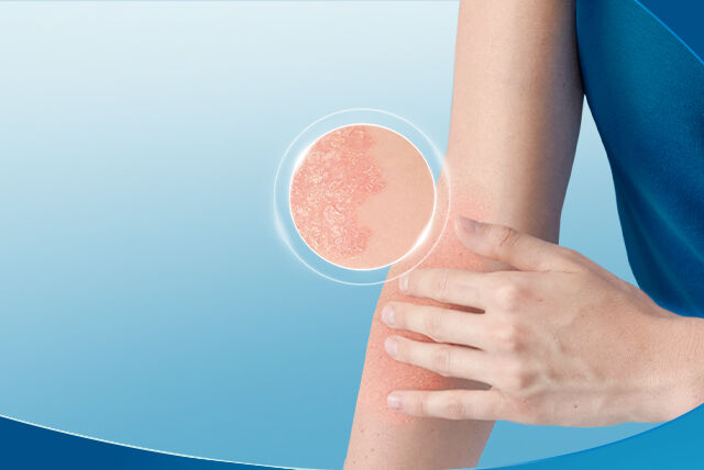 Manage Eczema-Prone Skin with Cetaphil Creams and Moisturizers | Cetaphil